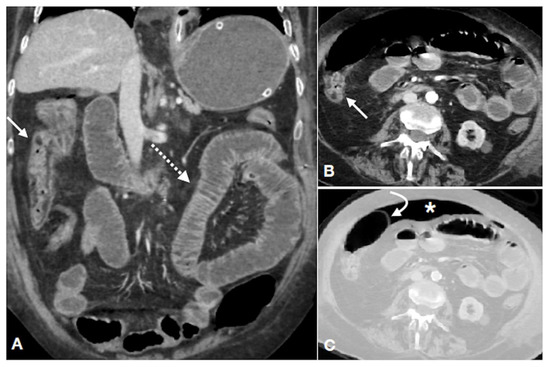 Large Bowel Ischemia/Infarction: How to Recognize It and Make ...