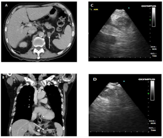 Transitioning to Combined EBUS EUS-B FNA for Experienced EBUS ...