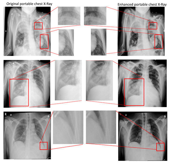 Diagnostics | Free Full-Text | Enhance Portable Radiograph for Fast and ...