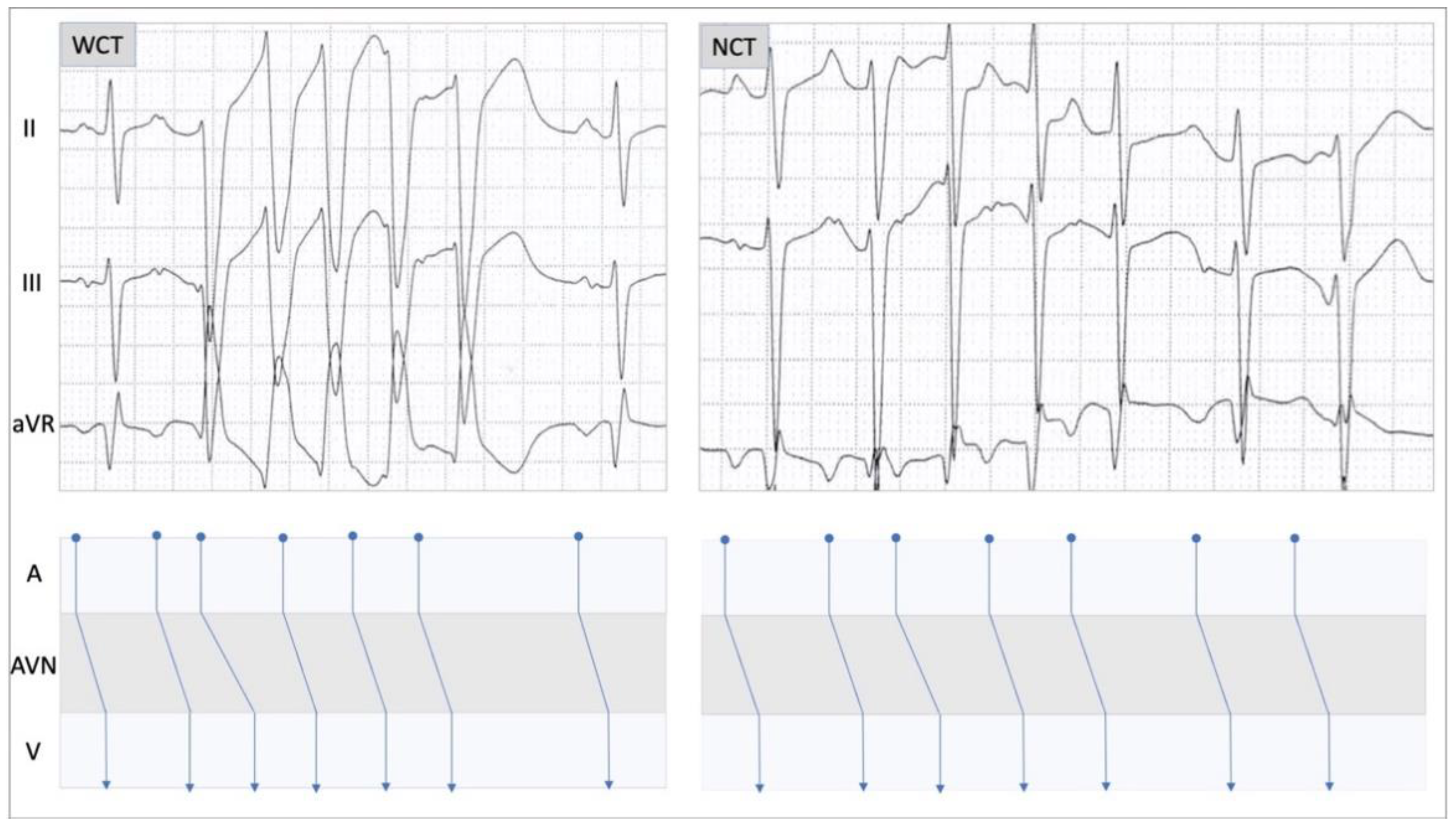 Wct Heart Rhythm
