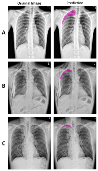 Automated Radiology Alert System for Pneumothorax Detection on Chest ...