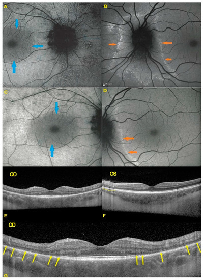 Acute Zonal Occult Outer Retinopathy (AZOOR) Results from a ...