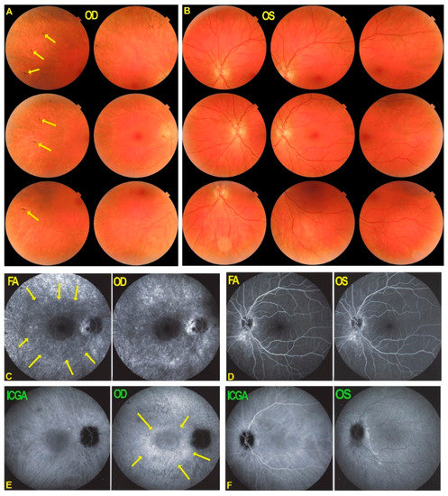 Acute Zonal Occult Outer Retinopathy (AZOOR) Results from a ...