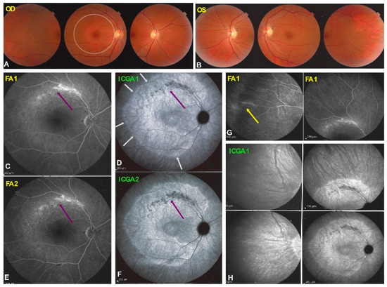 Acute Zonal Occult Outer Retinopathy (AZOOR) Results from a ...