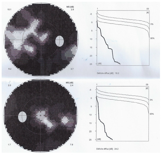 Acute Zonal Occult Outer Retinopathy (AZOOR) Results from a ...