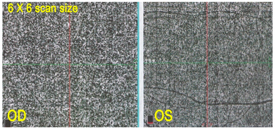 Acute Zonal Occult Outer Retinopathy (AZOOR) Results from a ...