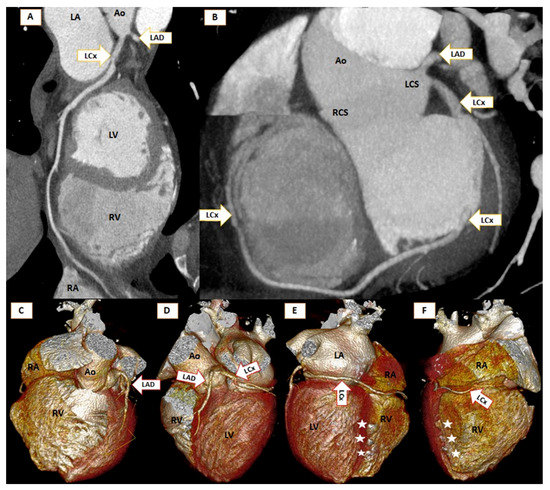 Absence of Both Right and Left Main Coronary in a COVID Survivor