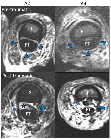 MRI of Finger Pulleys at 7T—Direct Characterization of Pulley Ruptures ...