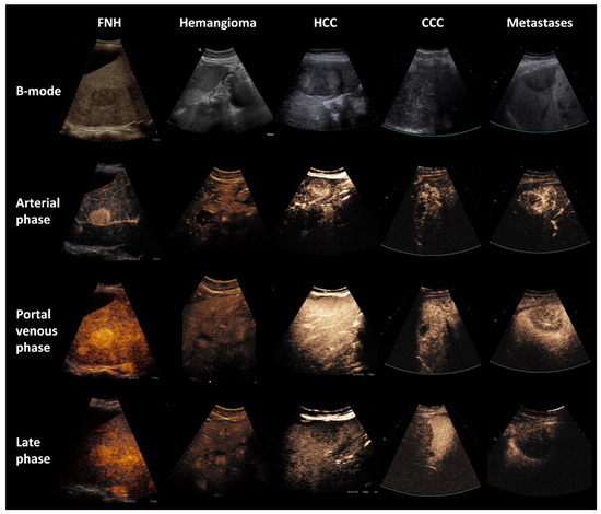 Quantitative Analysis of the Time–Intensity Curve of Contrast-Enhanced ...