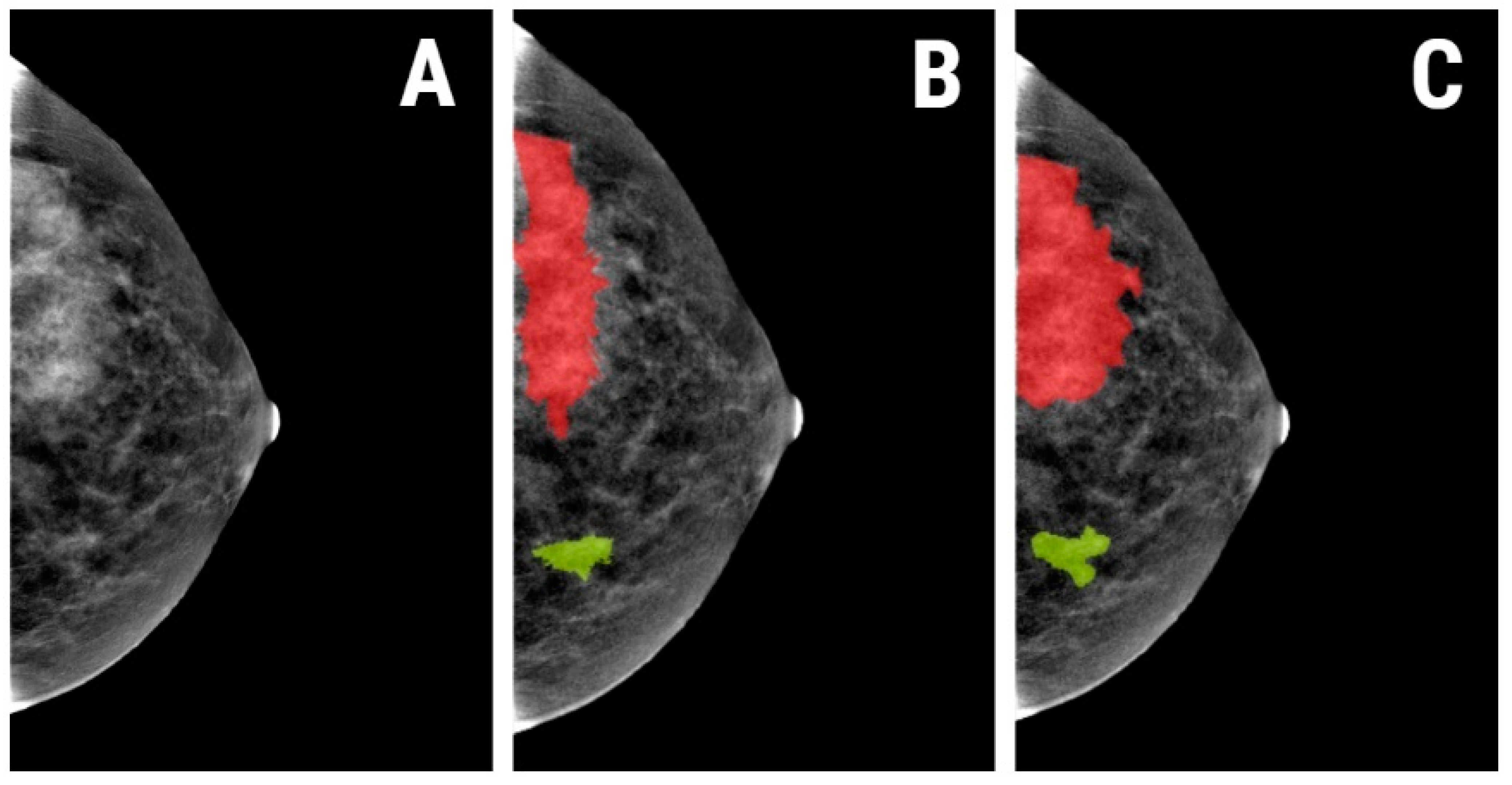 Diagnostics Free Full Text Differentiating Breast Tumors From