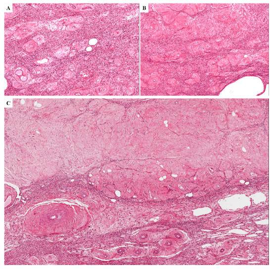 The Wide Morphological Spectrum of Deep (Aggressive) Angiomyxoma of the ...
