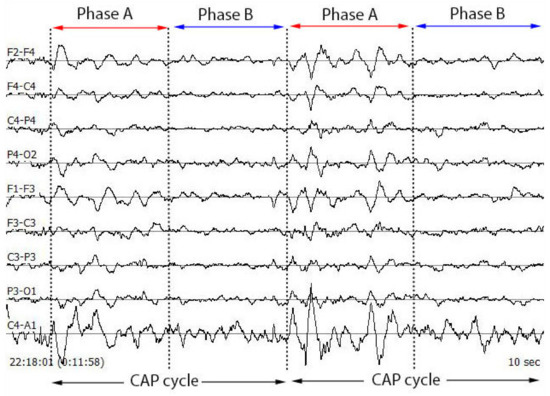 Automated Characterization of Cyclic Alternating Pattern Using Wavelet-Based Features and ...