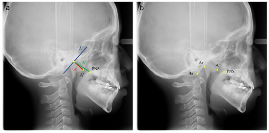 Automated Adenoid Hypertrophy Assessment with Lateral Cephalometry in ...