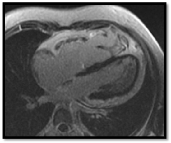Anatomical-MRI Correlations in Adults and Children with Arrhythmogenic ...
