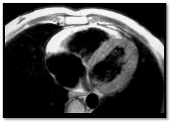 Anatomical-MRI Correlations in Adults and Children with Arrhythmogenic ...