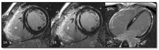 Anatomical-MRI Correlations in Adults and Children with Arrhythmogenic ...