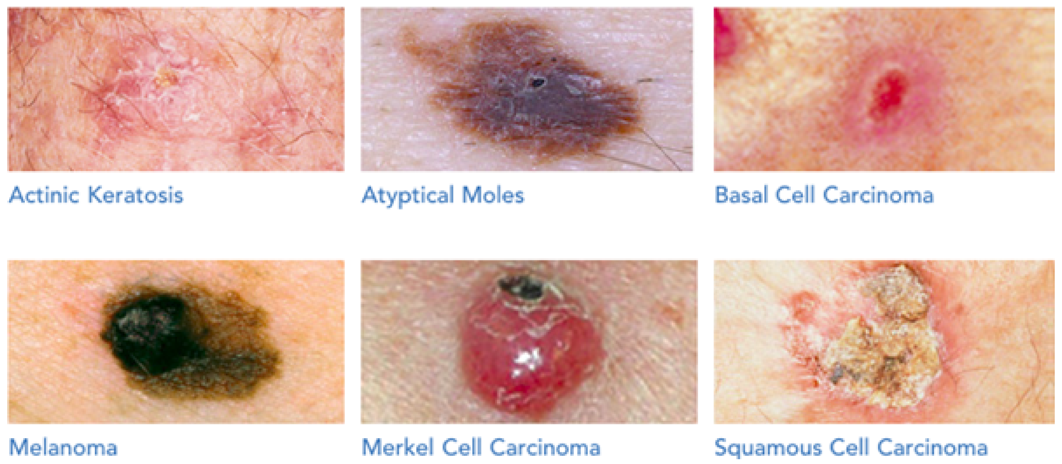 Pre Skin Cancer Keratosis