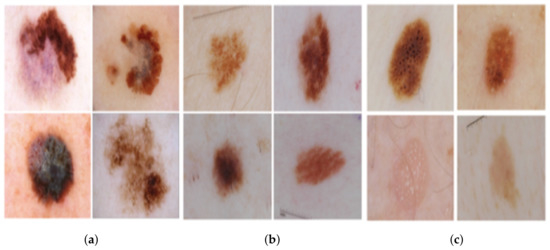Machine Learning and Deep Learning Methods for Skin Lesion ...