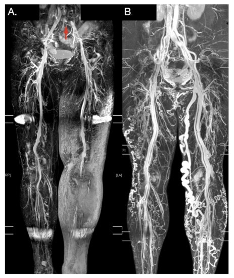 Using Non-Contrast MRA to Discriminate between Obstructive and ...