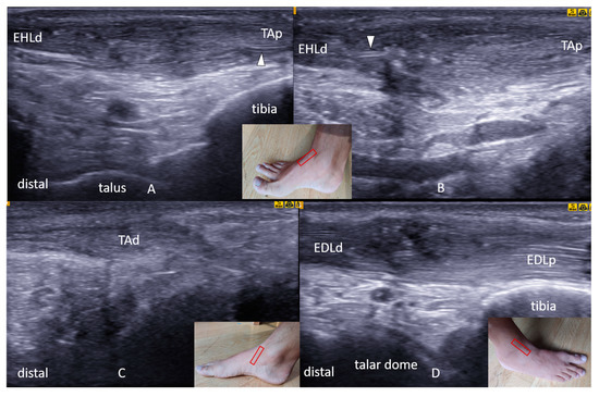 Ultrasound Examination and Navigation for Repeat/Delayed Reconstruction ...