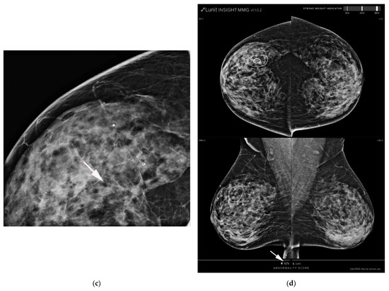 Diagnostic Performance of Artificial Intelligence-Based Computer-Aided Diagnosis for Breast ...