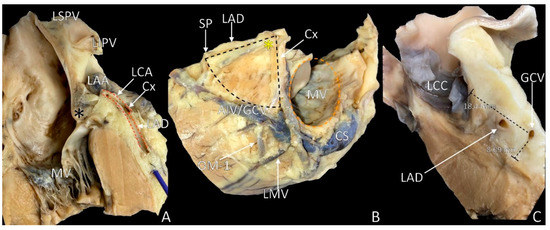 Left Ventricular Summit—Concept, Anatomical Structure and Clinical ...