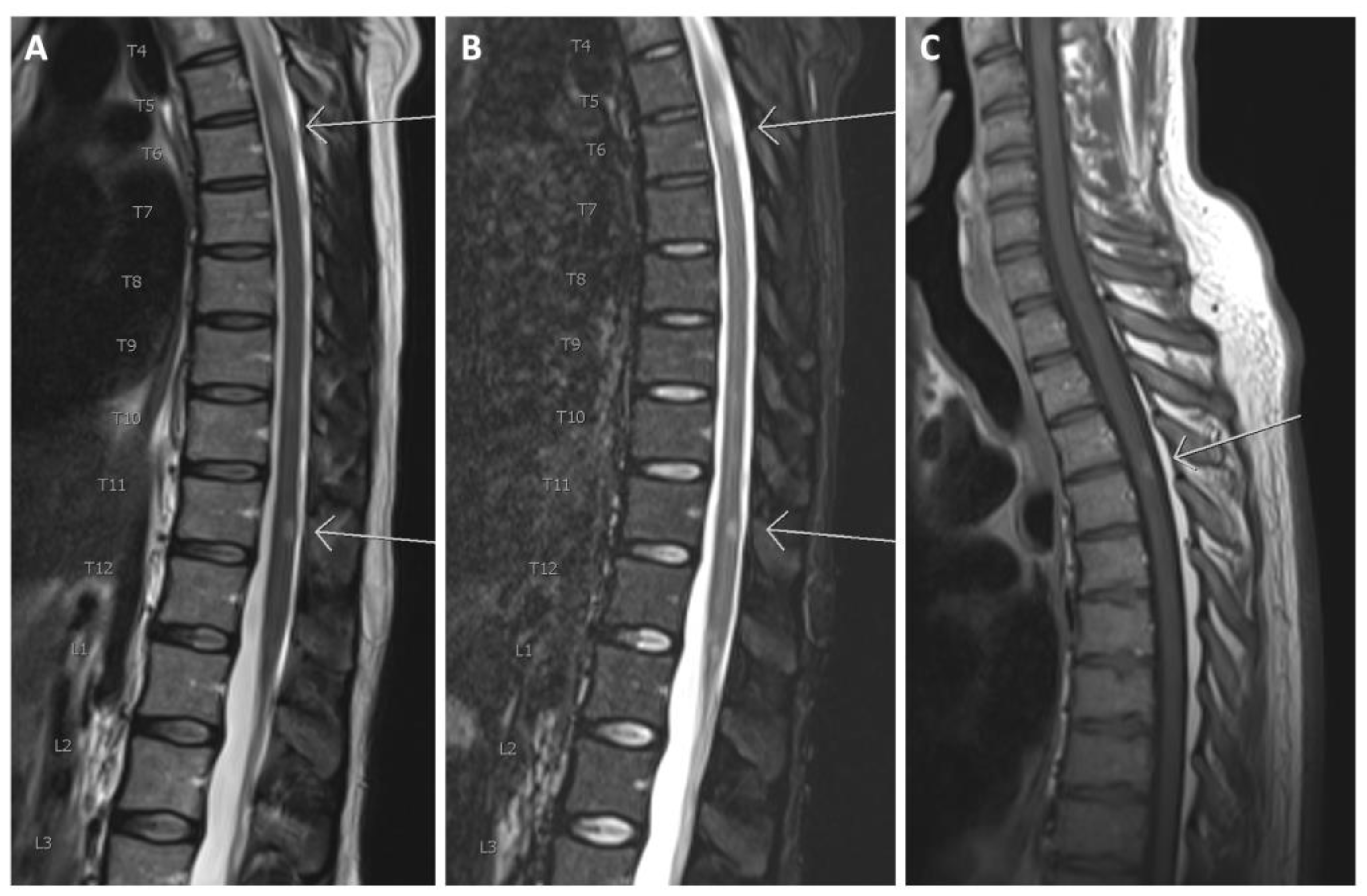 MRI of the Entire Spinal Cord—Worth the While or Waste of Time? A Retrospective Study of 74 ...