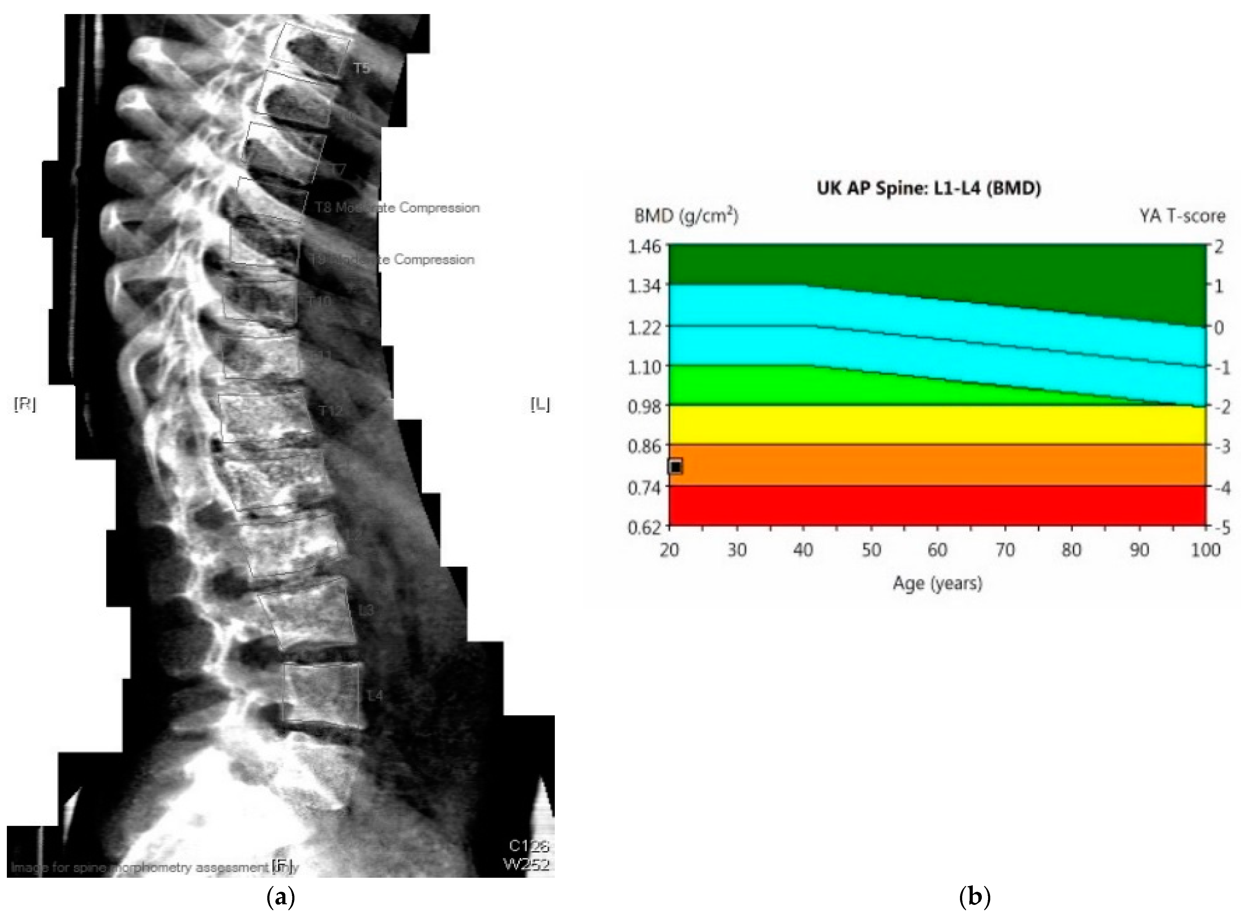 Skeletal and Bone Mineral Density Features, Genetic Profile in ...