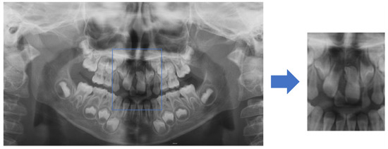 Automated Mesiodens Classification System Using Deep Learning on Panoramic Radiographs of Children