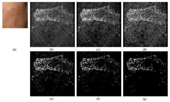 Computer-Aided Detection (CADe) System with Optical Coherent Tomography ...