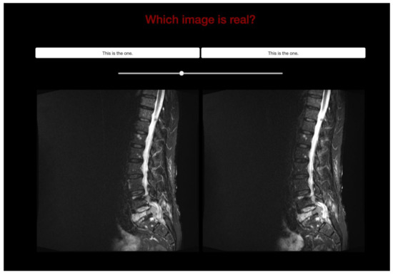 Generating Virtual Short Tau Inversion Recovery (STIR) Images from T1 ...