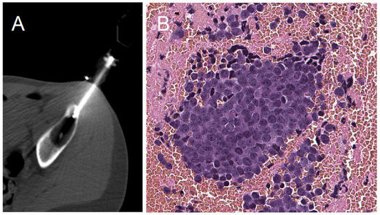 Diagnostics Free Full Text Percutaneous Core Needle Biopsy Can