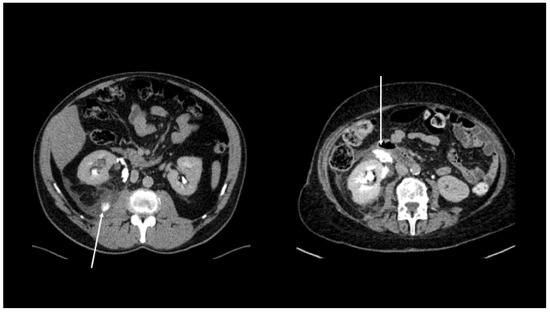 Spontaneous Upper Urinary Tract Rupture Caused by Ureteric Stones ...