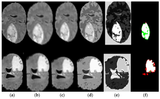 Brain Tumor Detection and Classification on MR Images by a Deep Wavelet ...