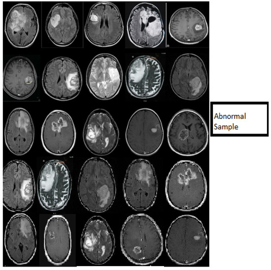 Brain Tumor Detection and Classification on MR Images by a Deep Wavelet ...