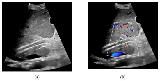 Diagnostic Value of Contrast-Enhanced Ultrasound for Evaluation of ...
