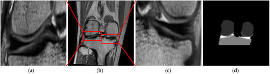 Automatic Meniscus Segmentation Using Adversarial Learning-Based Segmentation Network with ...