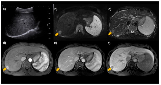 Magnetic Resonance Imaging for Surveillance of Hepatocellular Carcinoma ...