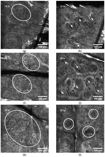 Acute Radiation Dermatitis Evaluation with Reflectance Confocal ...