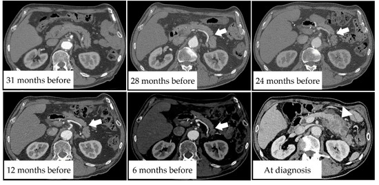 Focal Parenchymal Atrophy of the Pancreas Is Frequently Observed on Pre ...
