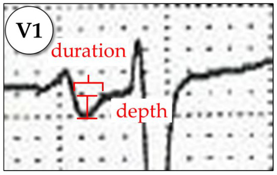 Diagnostics | Free Full-Text | Beat-to-Beat P-Wave Analysis Outperforms ...