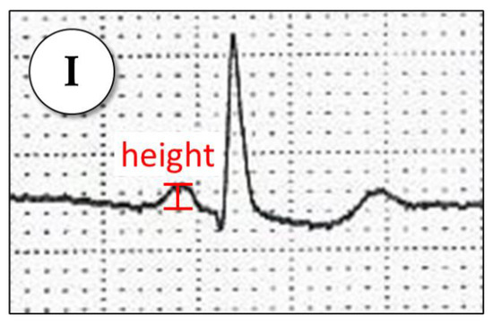 Diagnostics | Free Full-Text | Beat-to-Beat P-Wave Analysis Outperforms ...