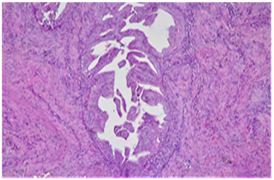 Patterns of Myometrial Invasion in Endometrial Adenocarcinoma with ...