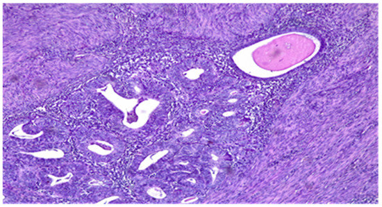 Patterns of Myometrial Invasion in Endometrial Adenocarcinoma with ...