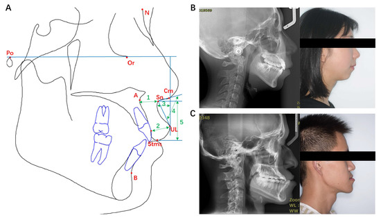 Association of Upper Lip Morphology Characteristics with Sagittal and ...
