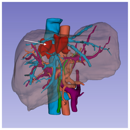 Hybrid Additive Fabrication of a Transparent Liver with Biosimilar ...