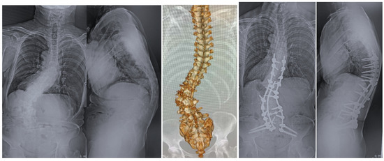 Assessment of 3D Lumbosacral Vascular Anatomy for OLIF51 by Non ...