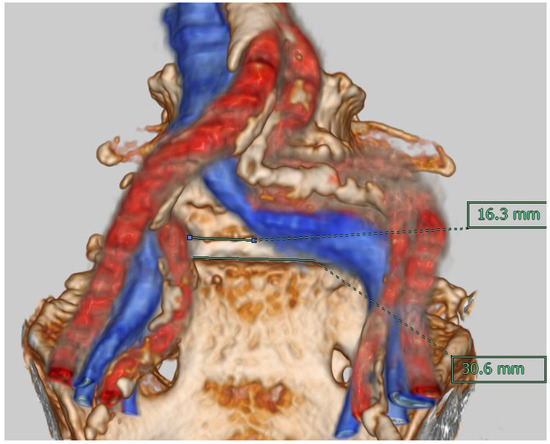 Assessment of 3D Lumbosacral Vascular Anatomy for OLIF51 by Non ...