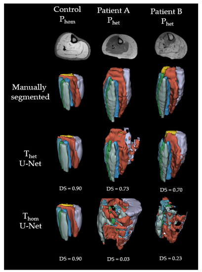 3D Automated Segmentation of Lower Leg Muscles Using Machine Learning ...