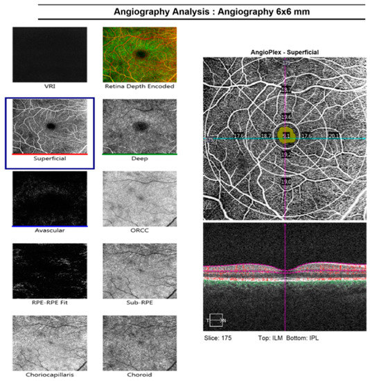 OCT-Angiography Findings in Patients with Amblyopia: Comparison between ...